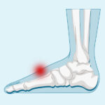 Tendinitis en el empeine del pie - Normalweb.es